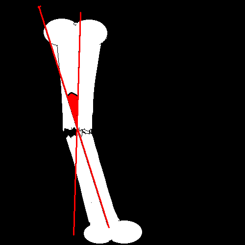 FRACTURE DISPLACEMENT